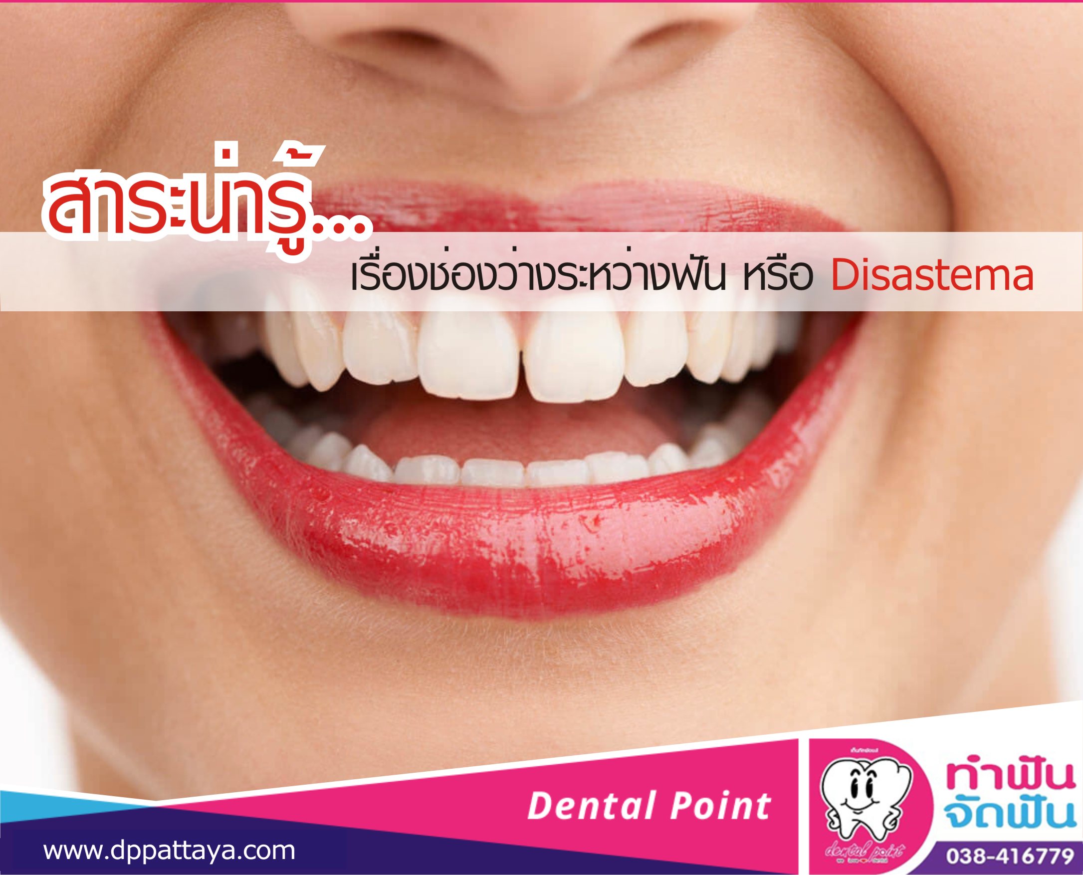 สาระน่ารู้...เรื่องช่องว่างระหว่างฟัน หรือ Diastema